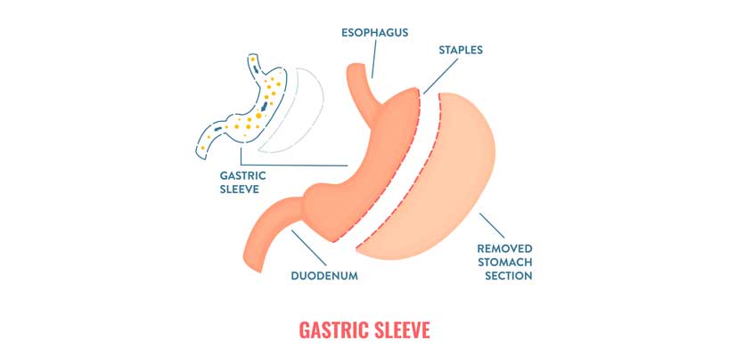 Gastric Sleeve vs. Gastric Bypass: What’s the Difference? - Magnolia ...