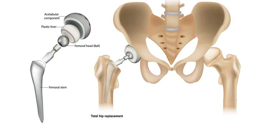 Am I Too Young for Total Hip Replacement Surgery? - Magnolia Regional ...